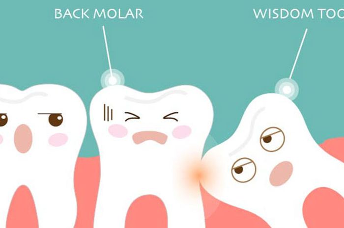 Impaksi Gigi Bungsu dan Penanganannya