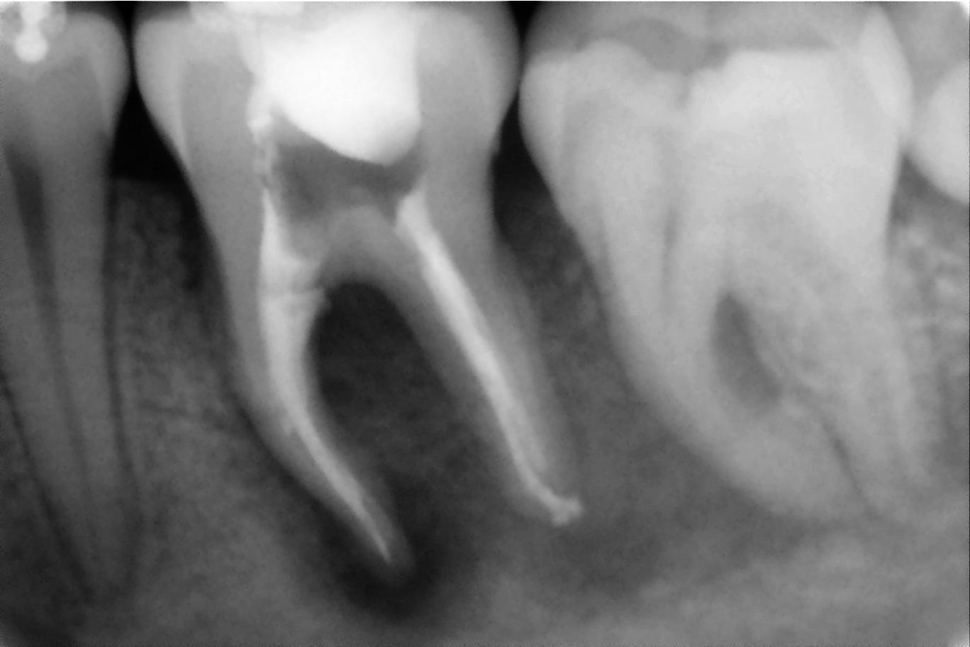 Caso clínico Máster: Necropulpectomía 36 con lima separada