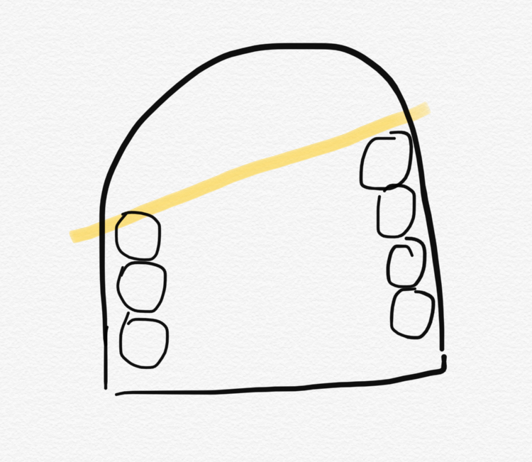 Dentowesome: Fulcrum Lines in RPD