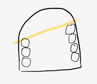 Dentowesome: Fulcrum Lines in RPD