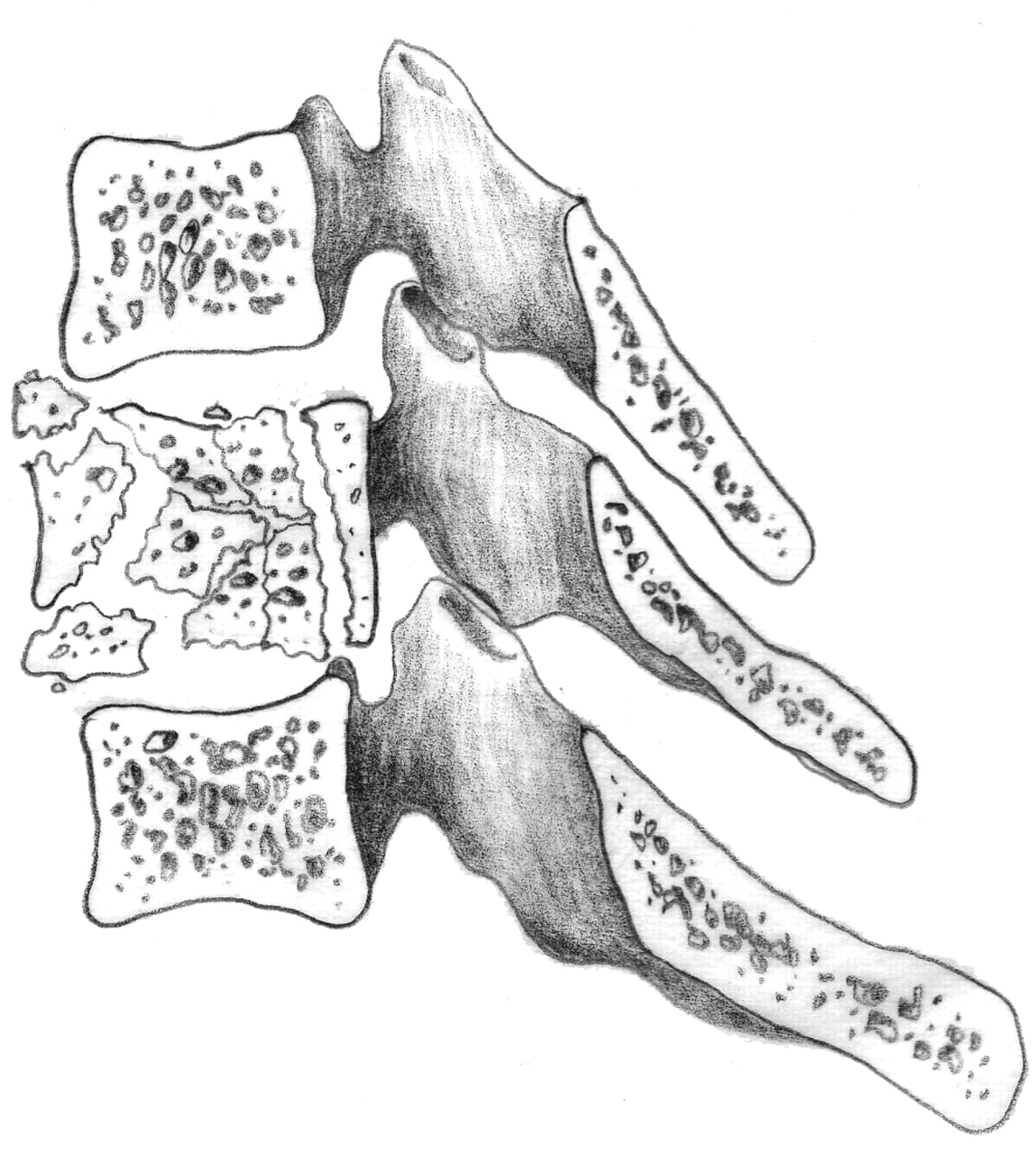 Burst Fracture Meddic