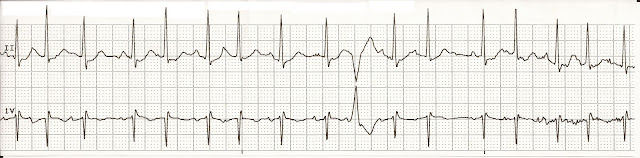 EKG Rhythm Strips 16: Atrial Rhythms