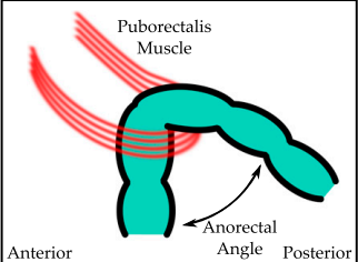 Caso clinico: Niño 3 años con Prolapso Rectal