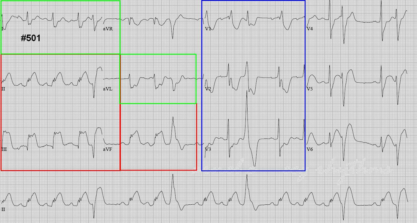 ECG Rhythms: Inferior Wall MI ECG Rhythms: Inferior Wall MI