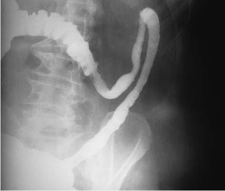 ON - RADIOLOGY: Ischaemic colitis Clinical and Radiological findings