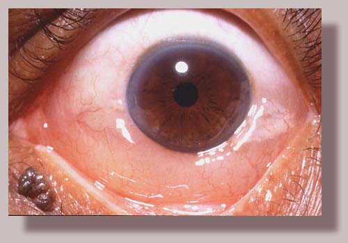 Photos For Chemosis ~ YOUNG DOCTORS' RESEARCH FORUM