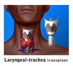 In's and Out's of a Laryngeal Transplant : Case Study of ...