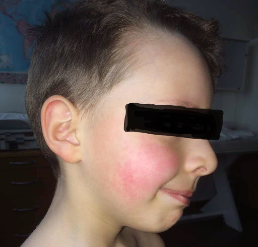 Dr Gamin Pédiatre : tout sur l'enfant: Mégalérythème épidémique (5ème ...