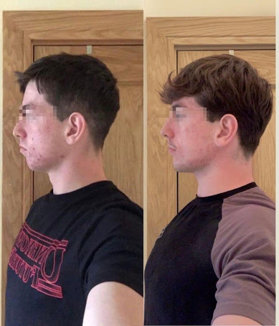 Những điều bạn cần biết về mewing ~ The beausty