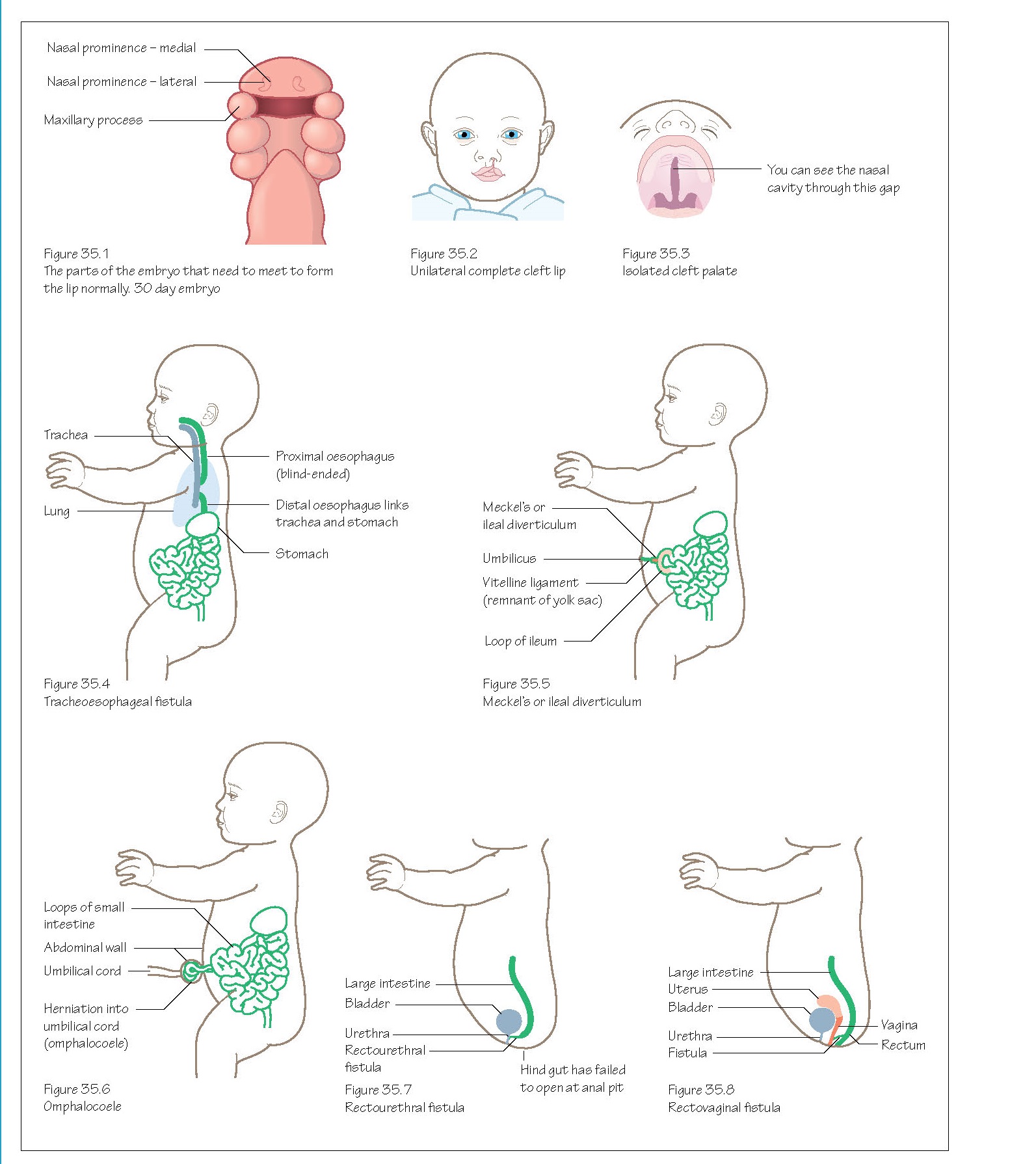 Congenital Anomalies - pediagenosis