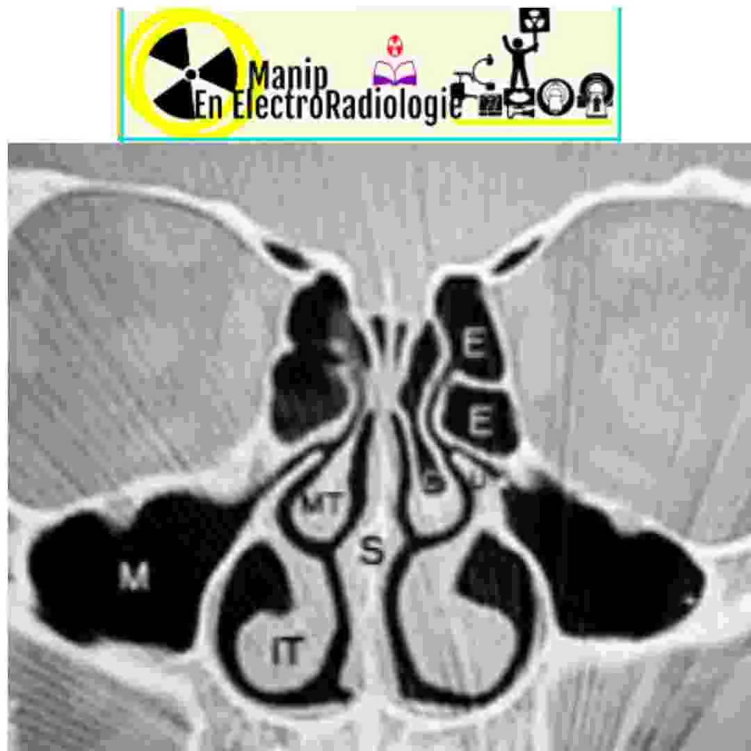 TDM CEREBRALE SCANNR CEREBRAL