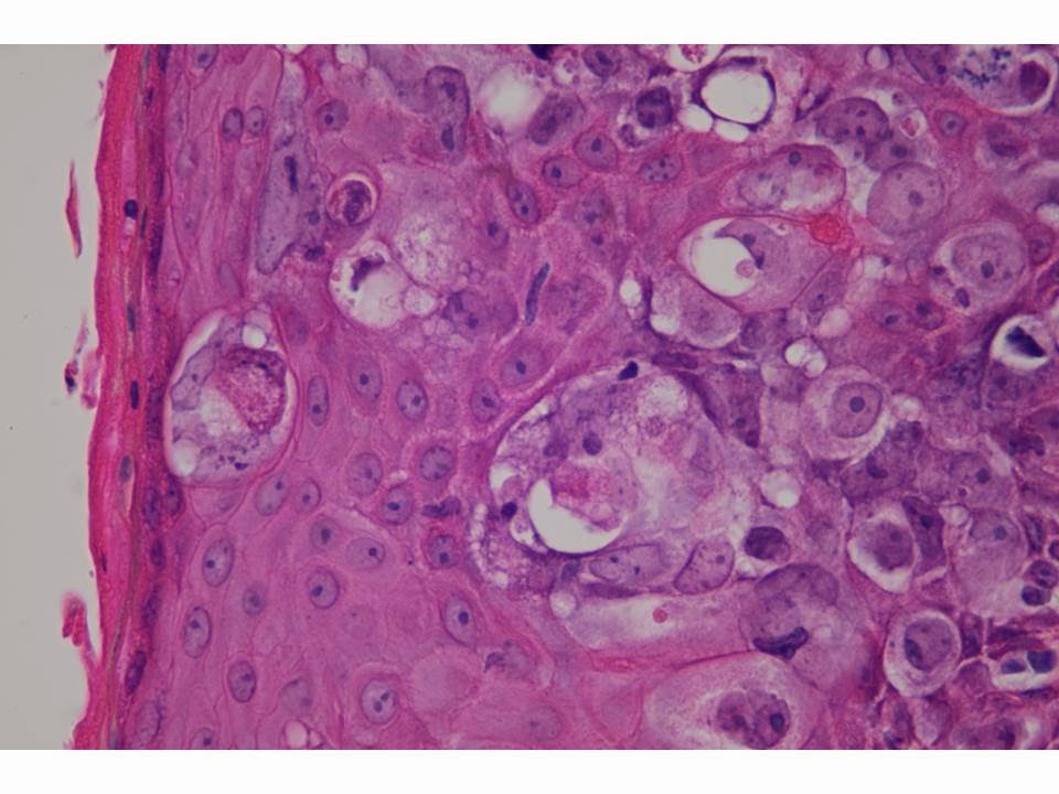 Dermpath Made Simple - Neoplastic: Other Malignant Epidermal Tumours