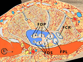 MRI Musculo-Skeletal Section: Palmar Bursae and Tendon Sheaths