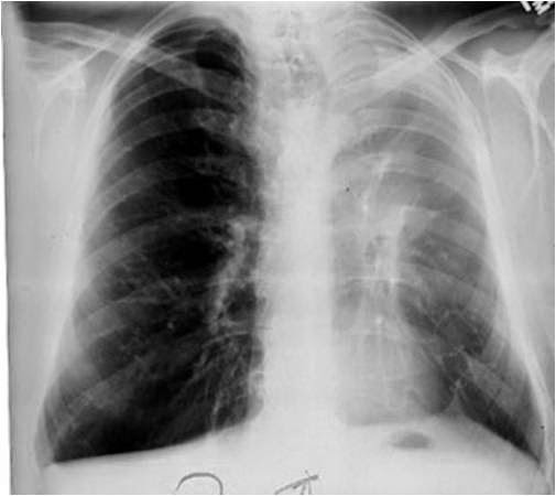 RADIOLOGY IMAGE SPOTTERS: Left upper lobe collapse