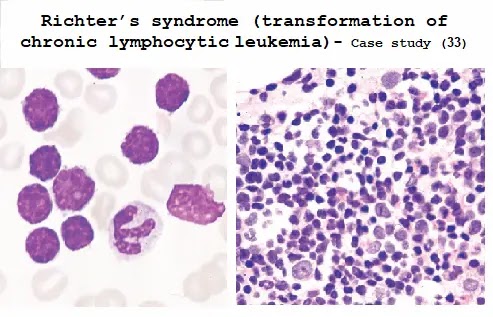 Case study (33) – Richter’s syndrome (transformation of chronic ...
