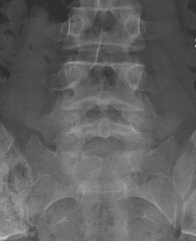 Spondylolysis or Pars Fracture | Growing Spine Blog | Washington ...