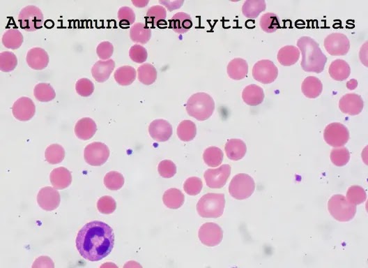 Autoimmune Hemolytic Anemias (AIHA)