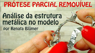 PRÓTESE DENTAL: Grampos utilizados em PPR - Odonto-Tv