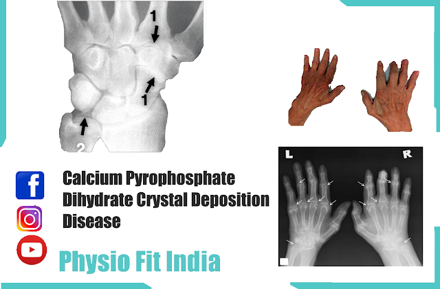 CPPD Calcium Pyrophosphate Dihydrate Crystal Deposition Disease