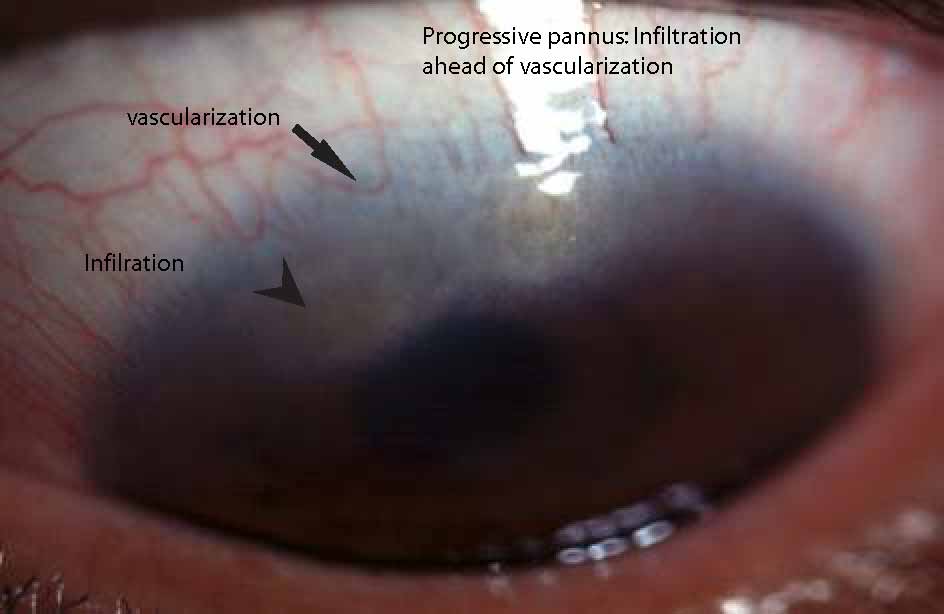 MBBS DOCTORS: Trachoma: Signs and Symptoms, Diagnosis, Treatment