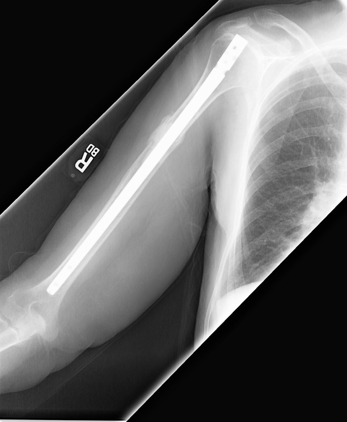 Shoulder and Elbow Surgery: Intramedullary nailing of bilateral ...