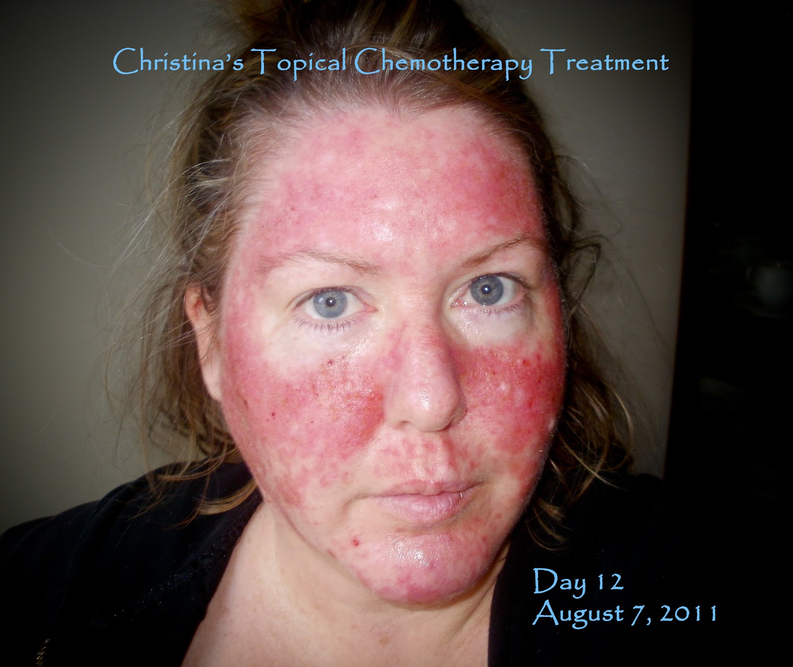 Chemo Rash On Face