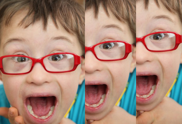 Sindome de Down : Enfermedades Asociadas al Síndrome de Down