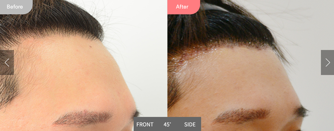 [ATOP Plastic Surgery Korea] Forehead Reduction (Forehead shortening ...