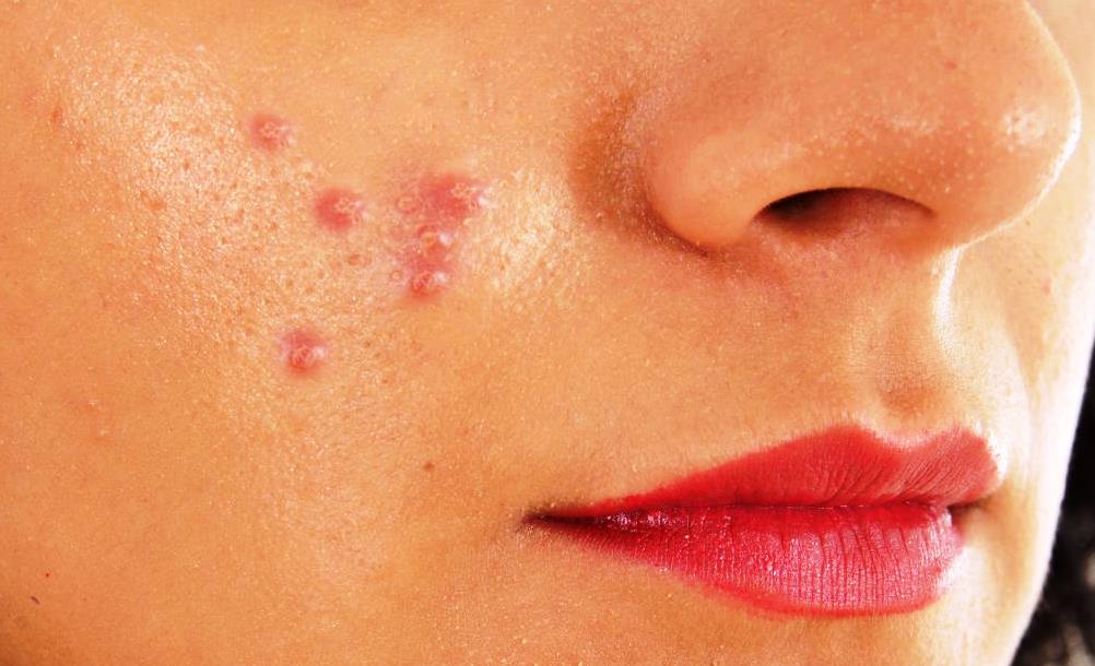 Getting Rid Of Pimples Fast And Naturally