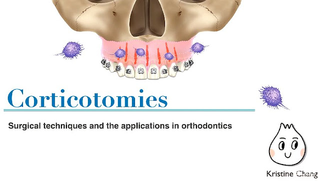 CORTICOTOMIES: Surgical techniques and the applications in orthodontics ...