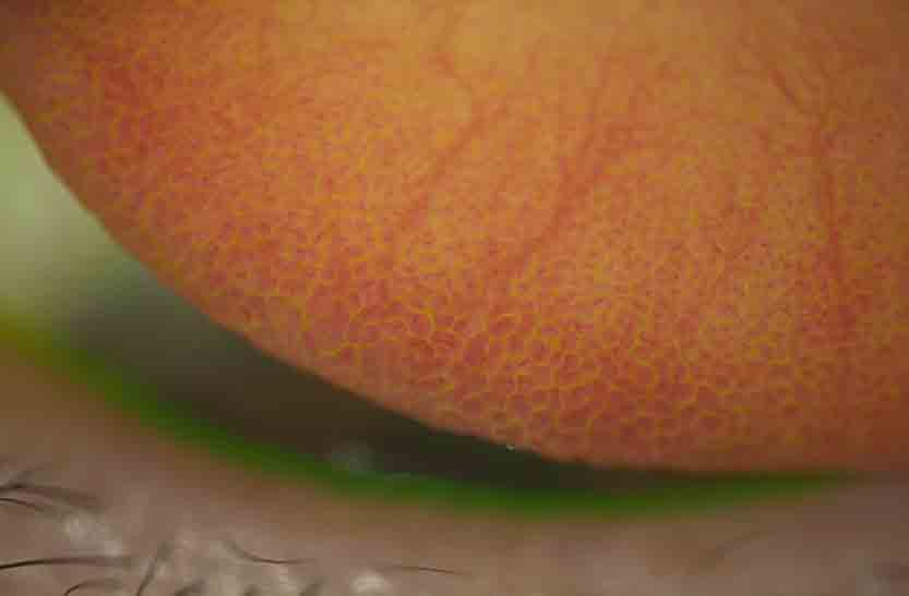 The Patient's Guide to Ocular Allergies - Eyedolatry