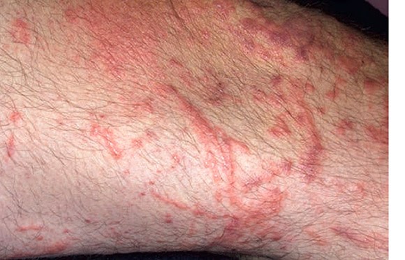 Rhus Dermatitis