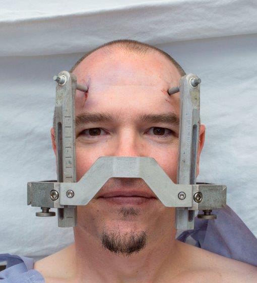 The Fading Angler: Play-by-Play Replay of Awake Neurosurgery