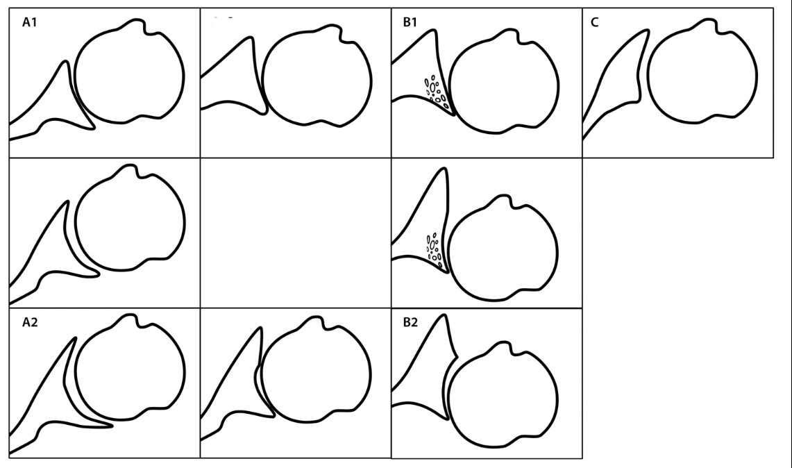 Shoulder arthritis - how may 'glenoid types' are there?