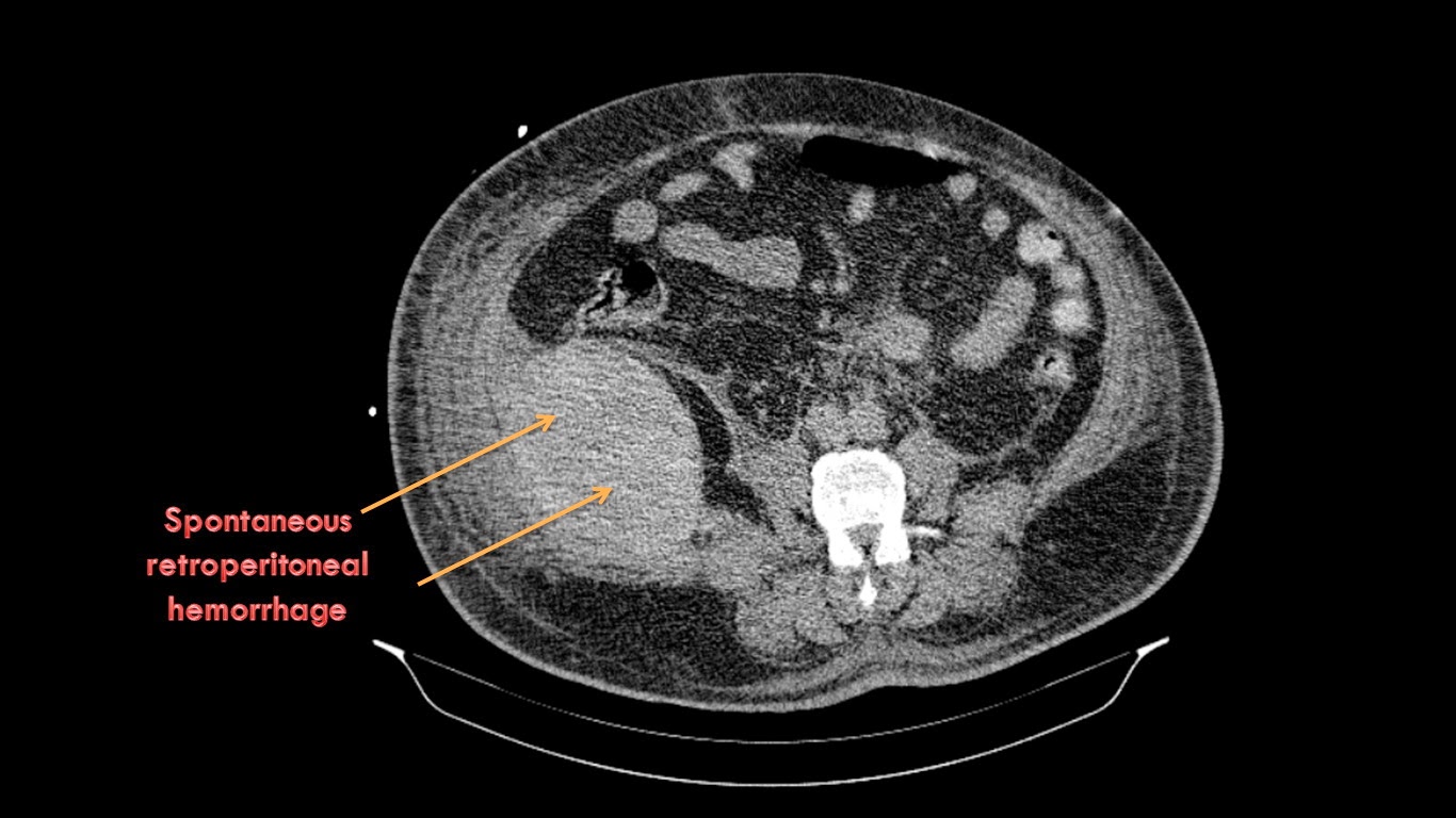 Retroperitoneal Bleed Ct Scan Ct Scan Machine My Xxx Hot Girl