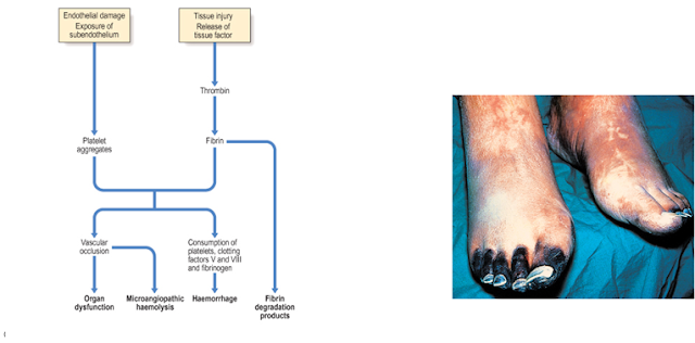MBBS Medicine (Humanity First): Pathogenesis of Disseminated ...