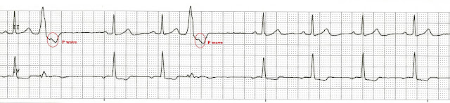 ECG Rhythm Strips 88