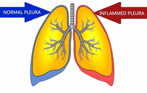 Life-saving Tips About Pleurisy & Ayurvedic Treatment - All Health Clue
