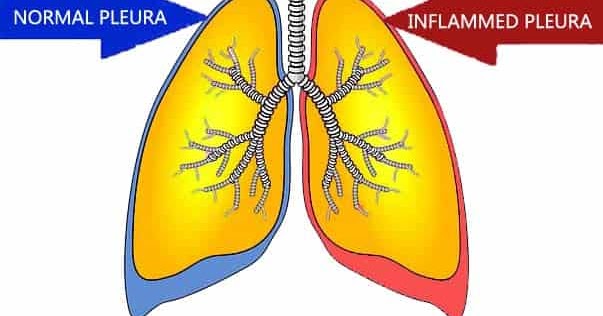 Life-saving Tips About Pleurisy & Ayurvedic Treatment - All Health Clue