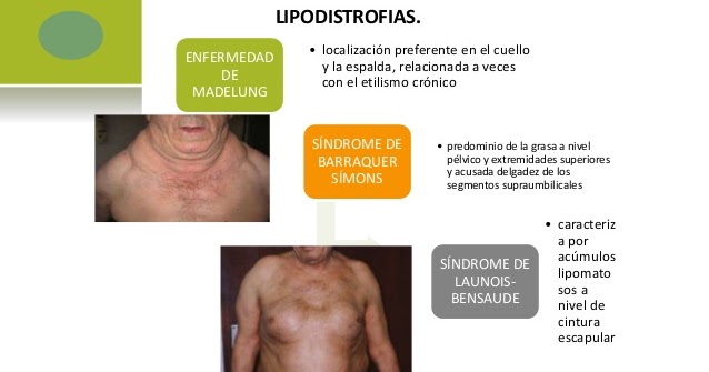 Discapaaccesible: Lipodistrofia parcial adquirida o Sindrome de Barraquer