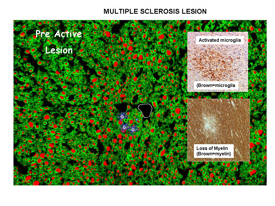 Multiple Sclerosis Research: Education. Espresso Pathology. Lesion ...