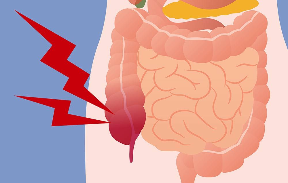 5 Warning Signs of Appendicitis You Shouldn't Ignore