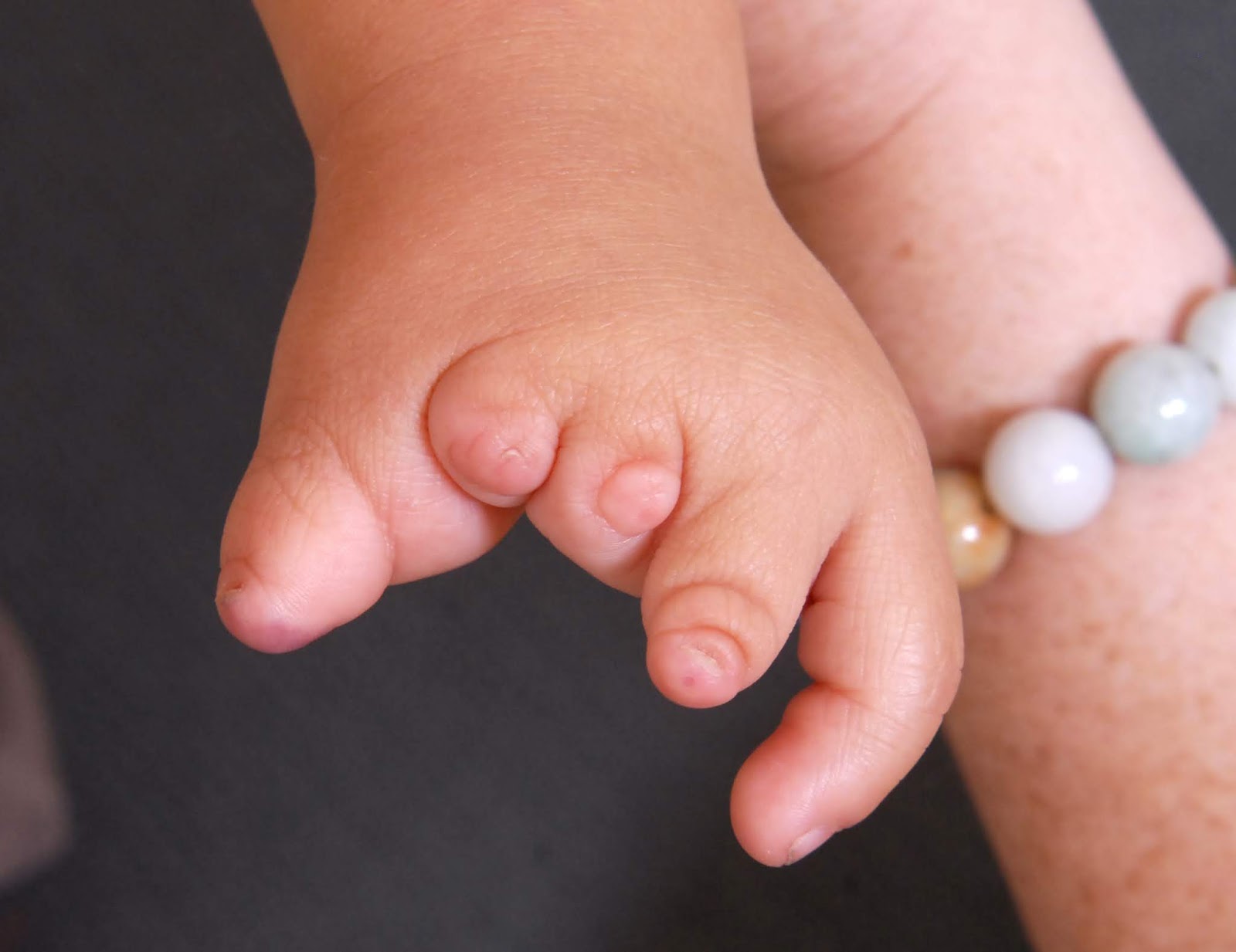 Amniotic Band Syndrome Toes