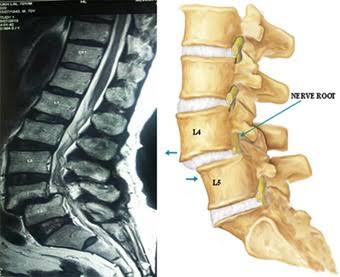 Spine Info: Listhesis