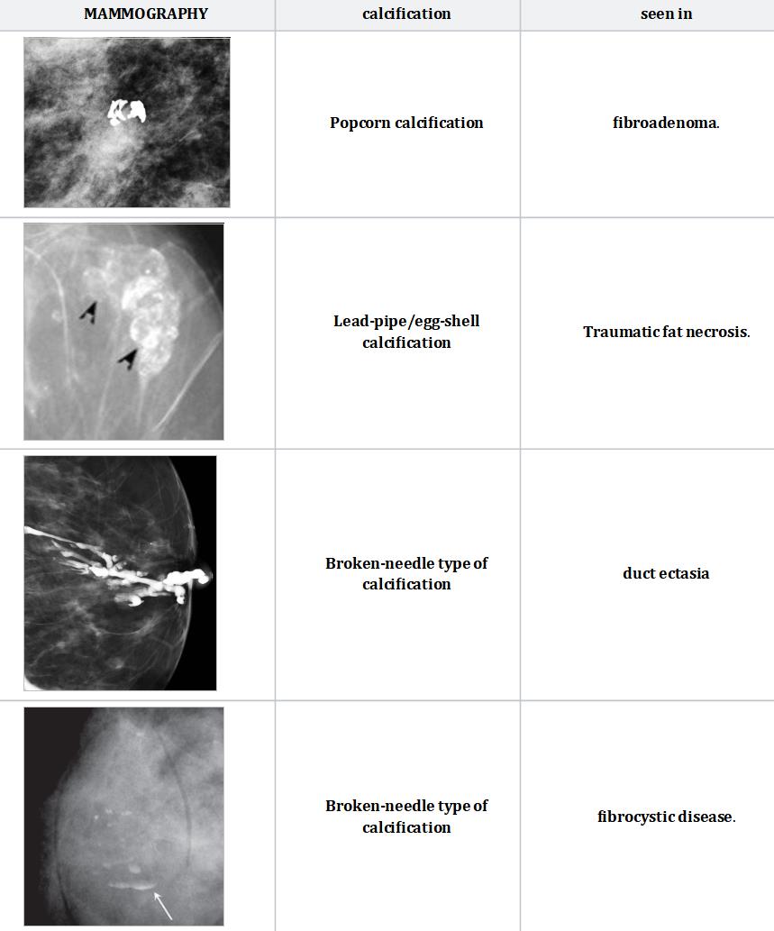 Benign Calcifications in Mammography.