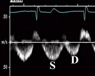 ASE Guidelines for the Diagnosis of Tricuspid Regurgitation