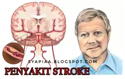 Ibuzahra Journey: Jenis-Jenis Stroke dan Cara Alternatif Mengatasinya.