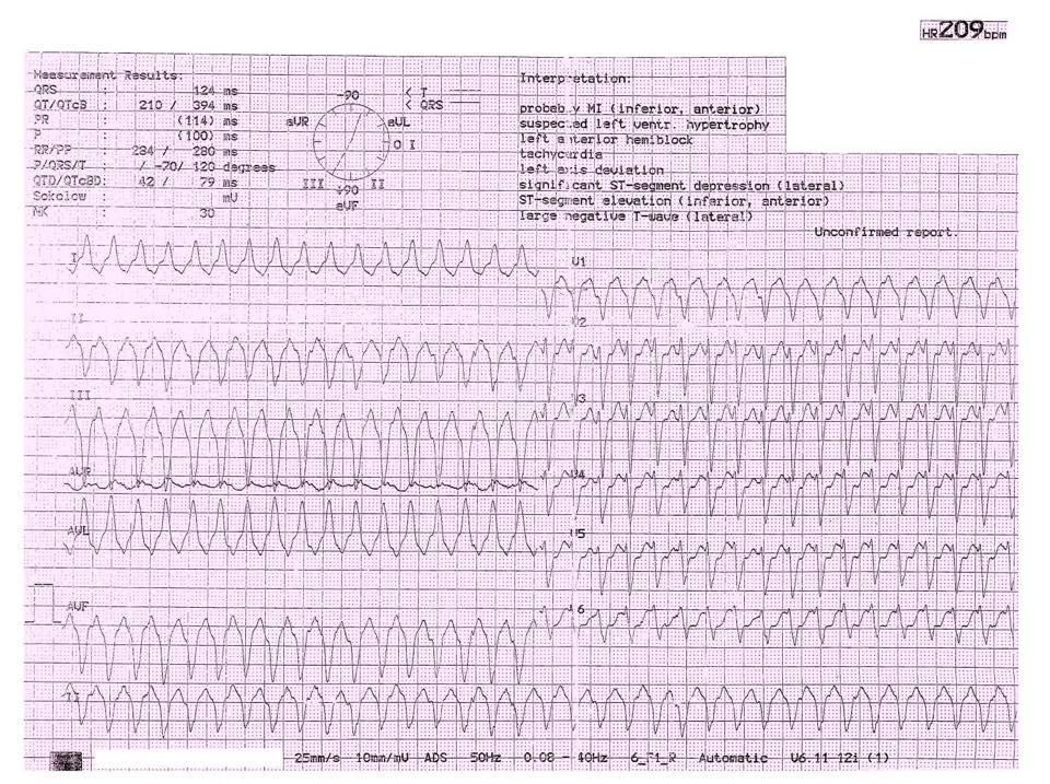 Clinical Electrocardiology ECG Blog: 2016