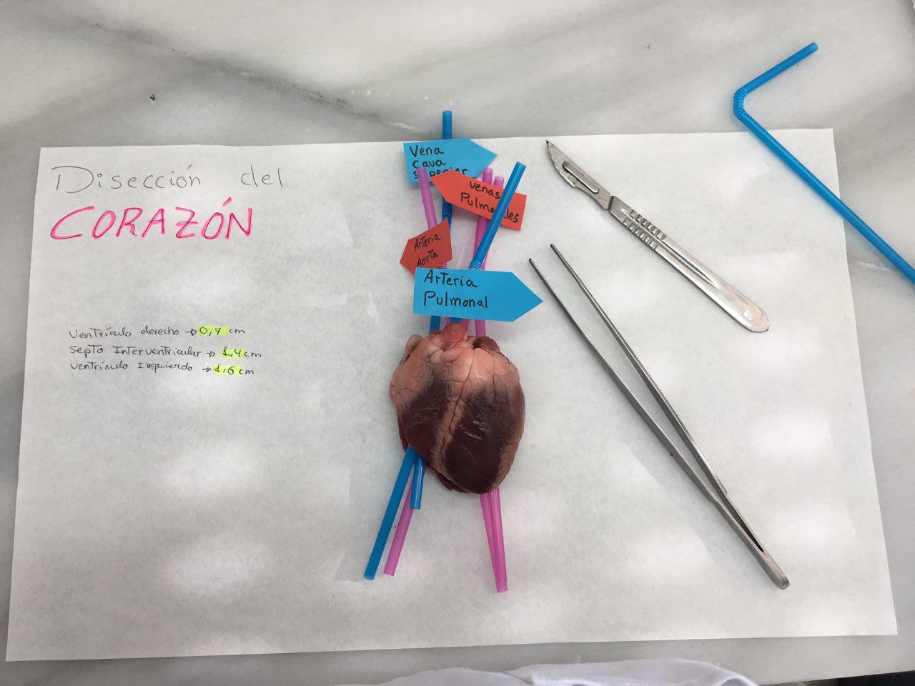 Disección de corazón