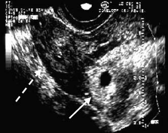Ob/Gyn Updated : Blob and Bagel sign on Ultrasound can be labelled as ...